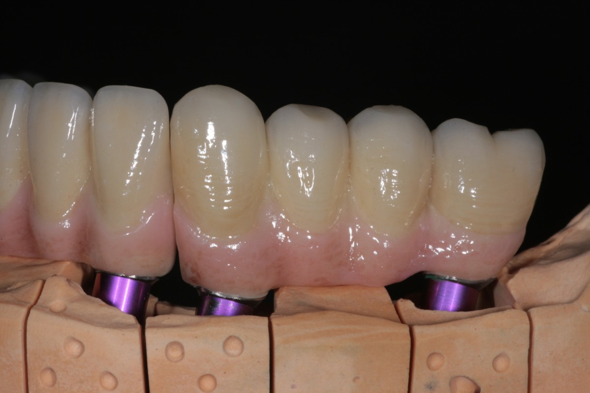 Festsitzender Zahnersatz - Thumfart's Zahntechnik GmbH