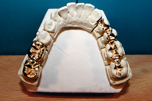 gold_inlay_2 - Thumfart's Zahntechnik GmbH